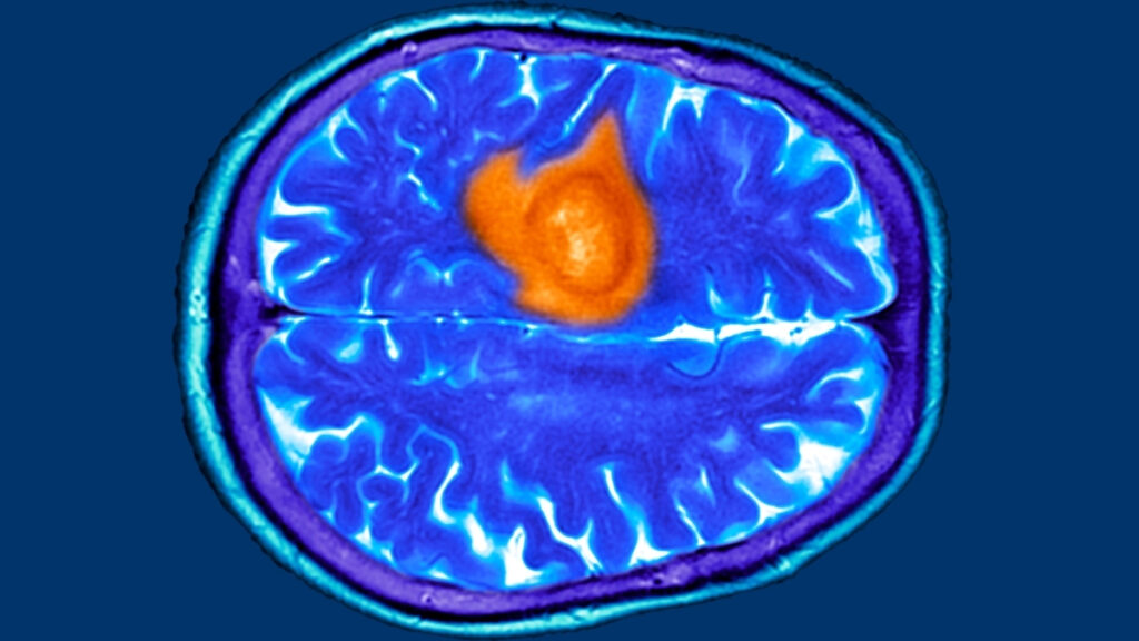 Recognizing Brain Cancer: 7 Subtle Signs That Matter